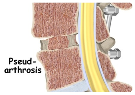 Non Union of Spine